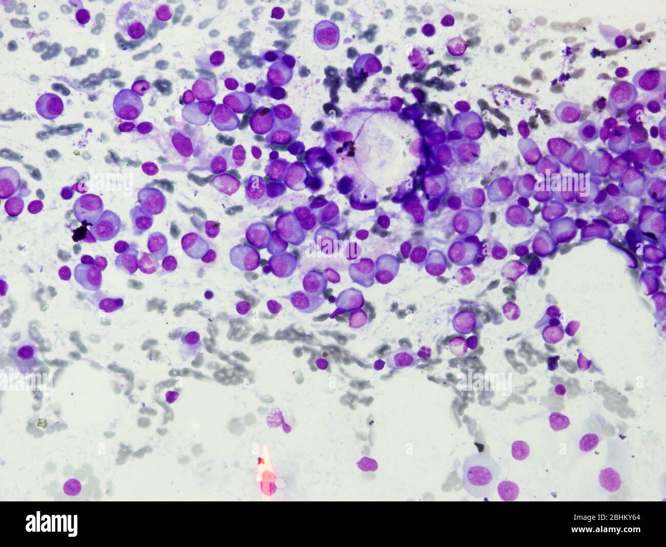 Microscopic image of Multiple Myeloma. Multiple Myeloma is type of cancer, it occurs then a ...