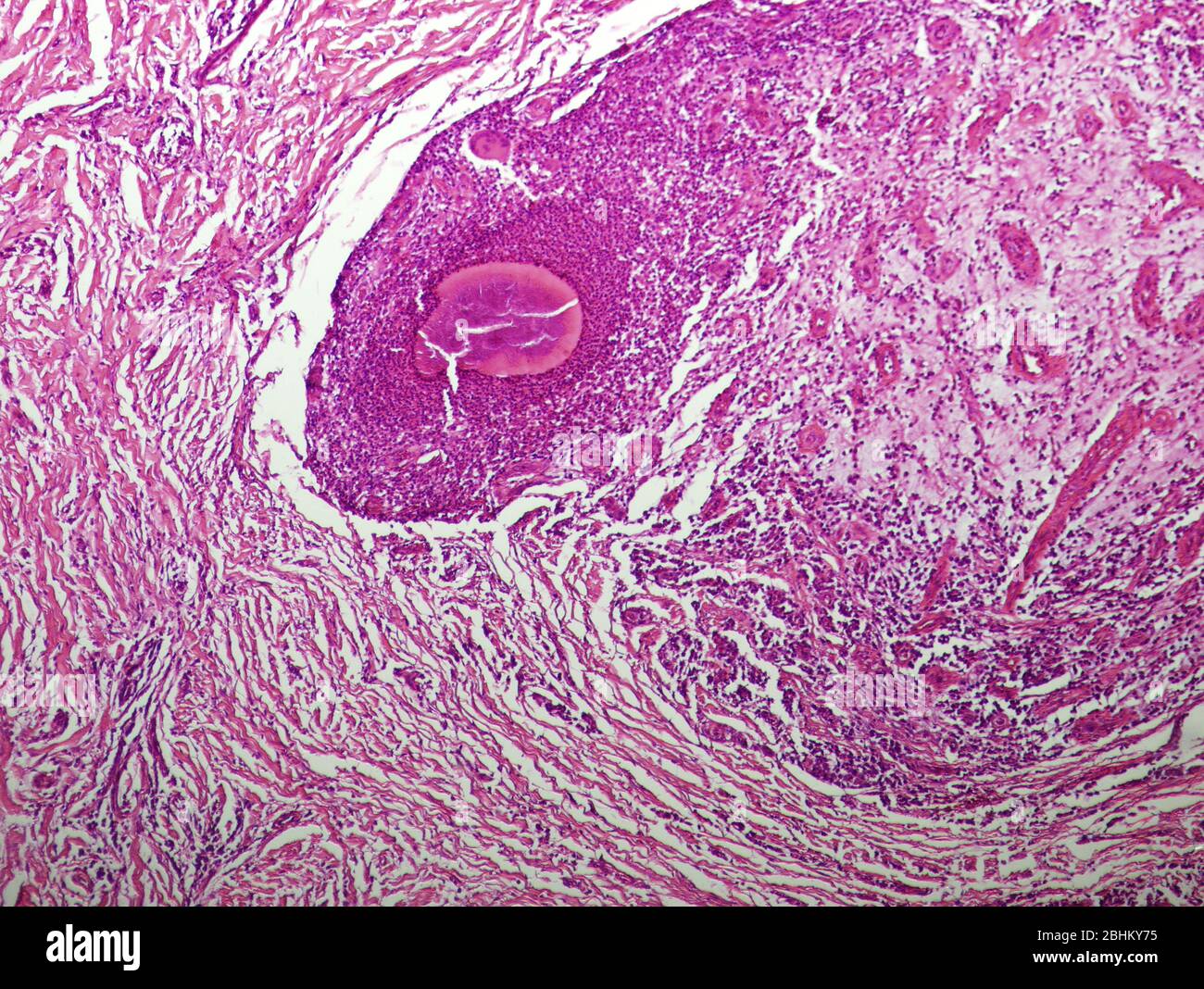 Microscopic image of Mycetoma. Mycetoma is a disease that is usually ...