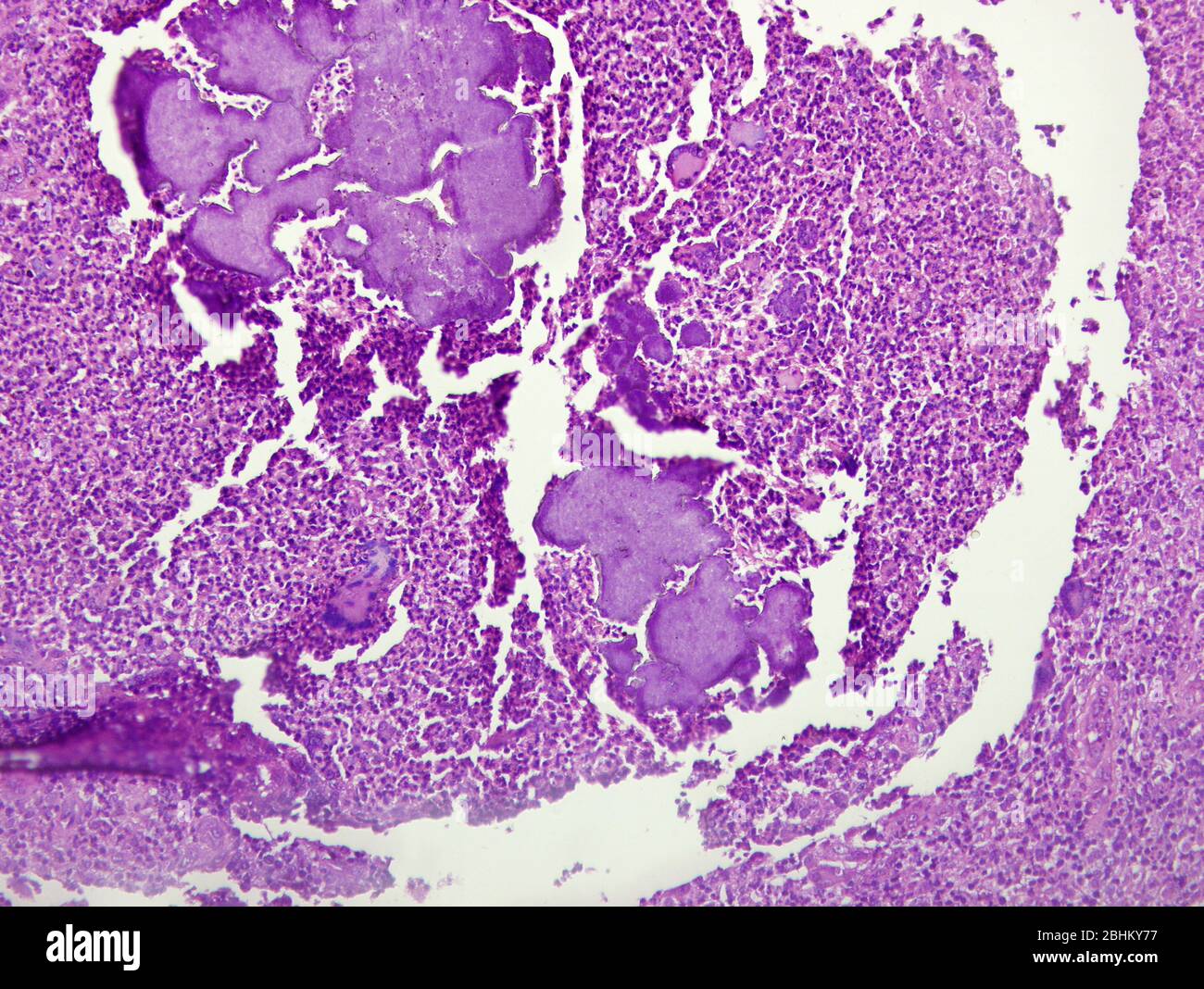 Contract a disease hi-res stock photography and images - Alamy
