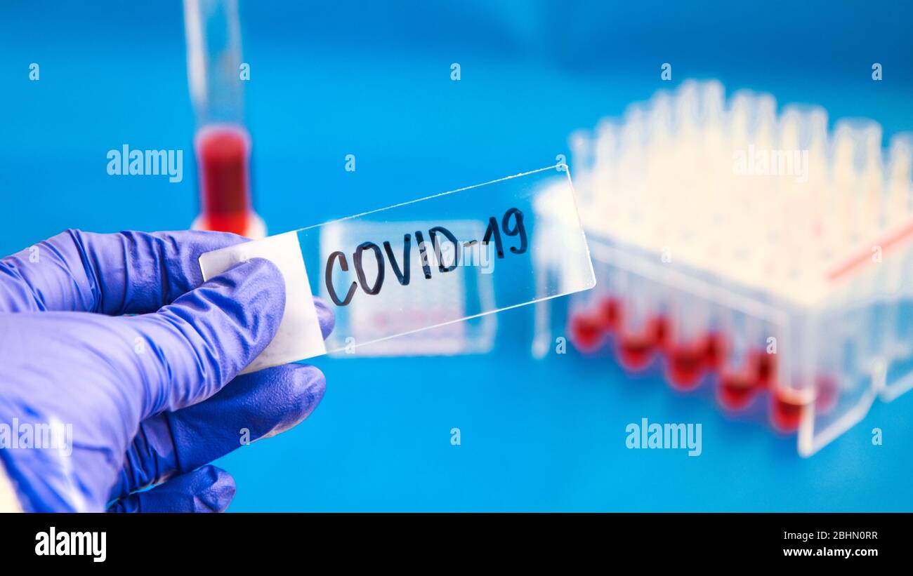Coronavirus Blood Sample, DNA testing of the blood in the laboratory ...