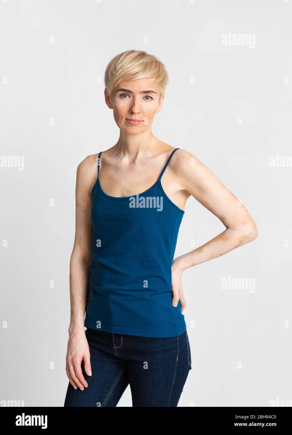 Slender woman with violation of skin pigmentation Stock Photo - Alamy