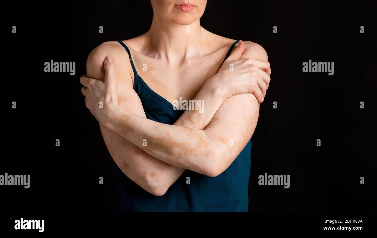 Woman suffering from chronic skin condition problem Stock Photo - Alamy Woman suffering from chronic skin condition problem Stock Photo - Alamy