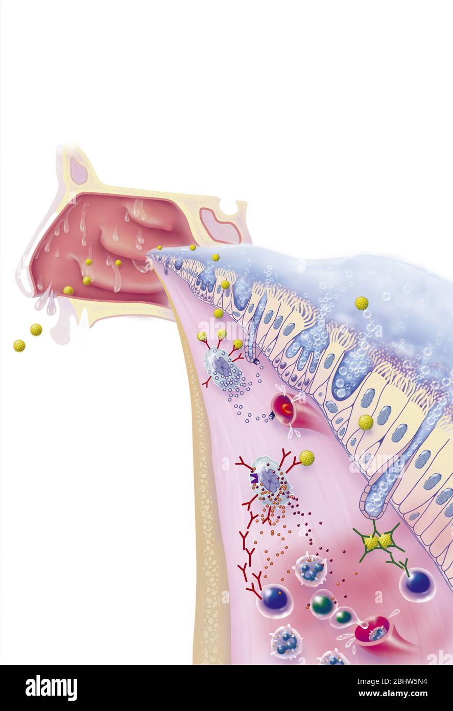Nasal congestion, detail of nasal mucosa, allergen, allergic reaction ...
