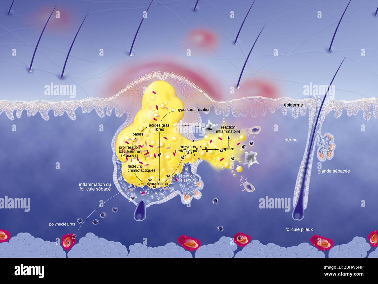 Acne around the hair follicle, sebaceous hypersecretion ...