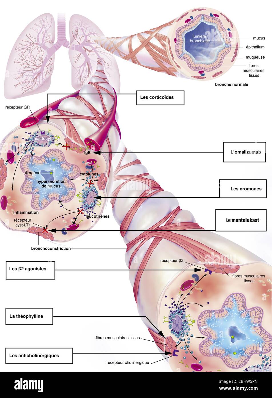Asthma, Normal bronchiole, asthmatic bronchiole with ...