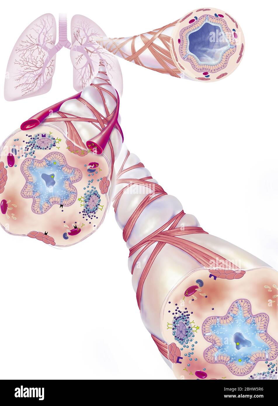 Asthma, Normal bronchiole, asthmatic bronchiole with ...