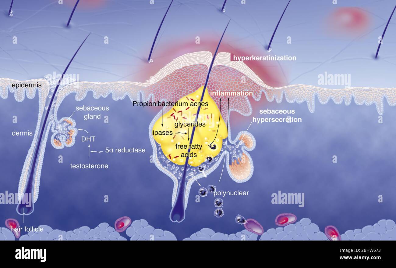 Acne around the hair follicle with inflammation, sebaceous ...