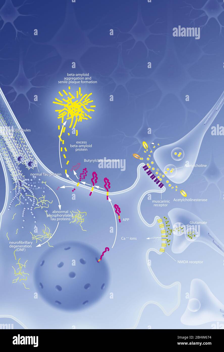 Neuron with neurofibrillary degeneration process, senile plaque ...