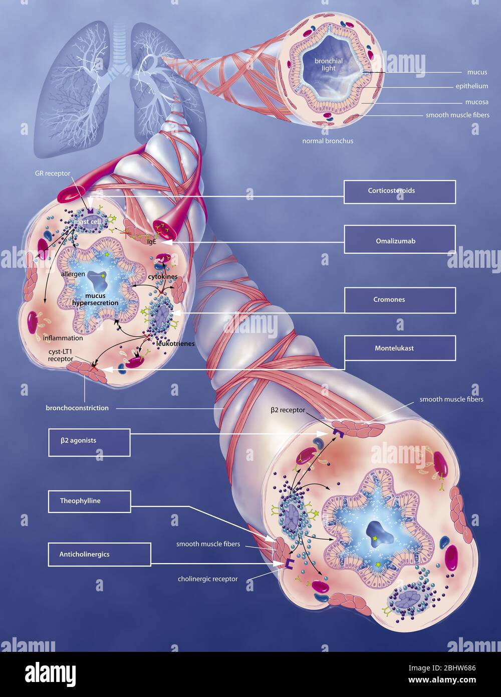 Asthma and its treatments. Representation of the lungs with the ...
