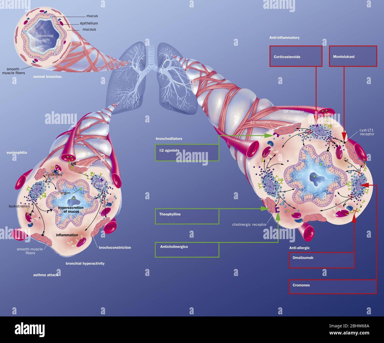 Asthma, Normal bronchiole, asthmatic bronchiole with ...