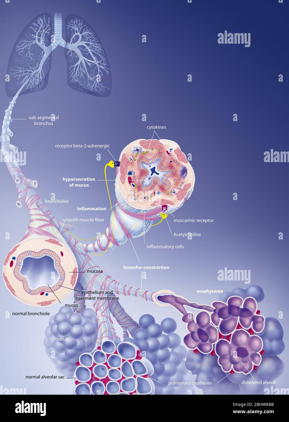 Lung tissue emphysema hi-res stock photography and images - Alamy
