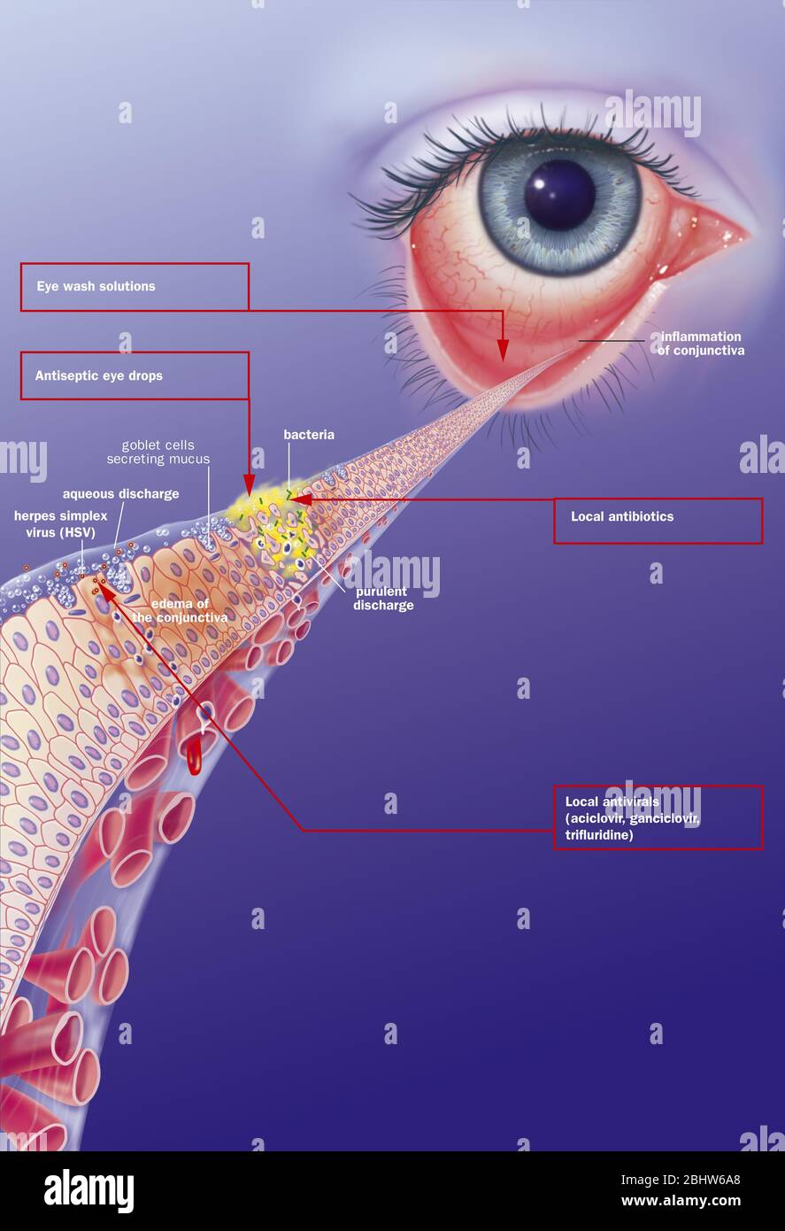 Infectious conjunctivitis and its treatments. View of an eye with ...