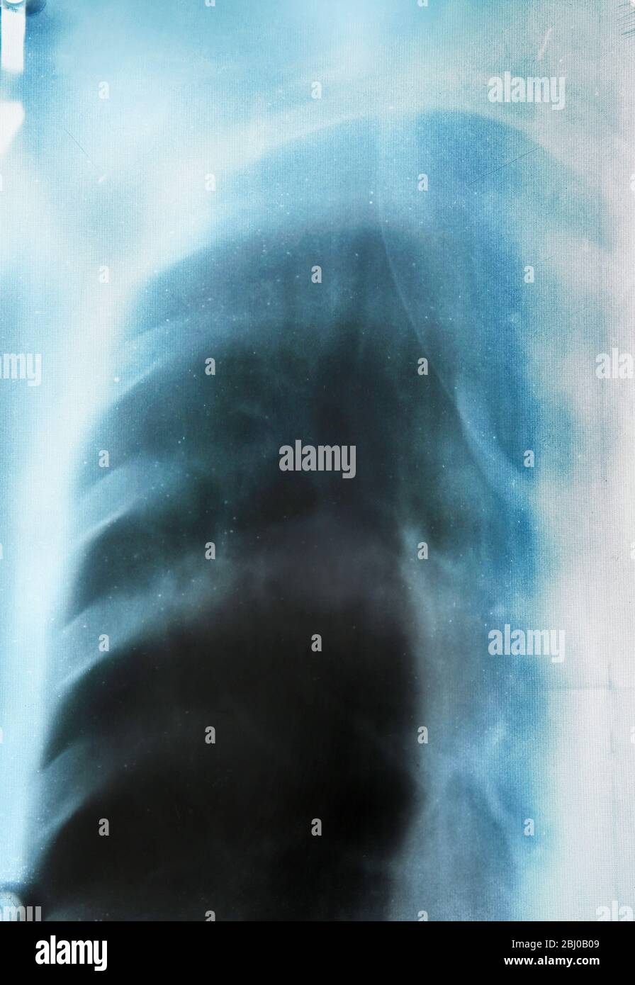 X-ray of human chest, closeup Stock Photo - Alamy