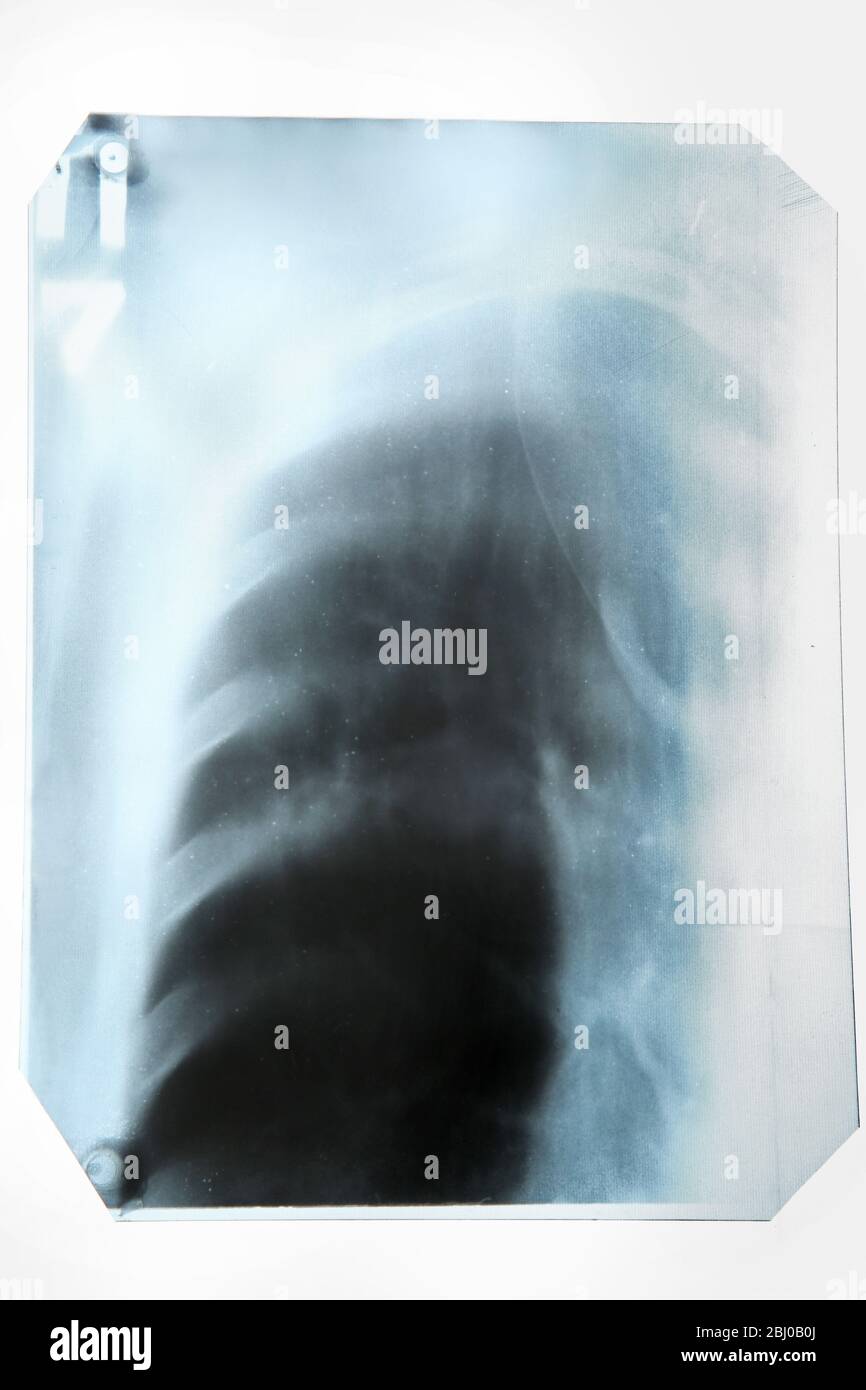 X-ray of human chest, closeup Stock Photo - Alamy
