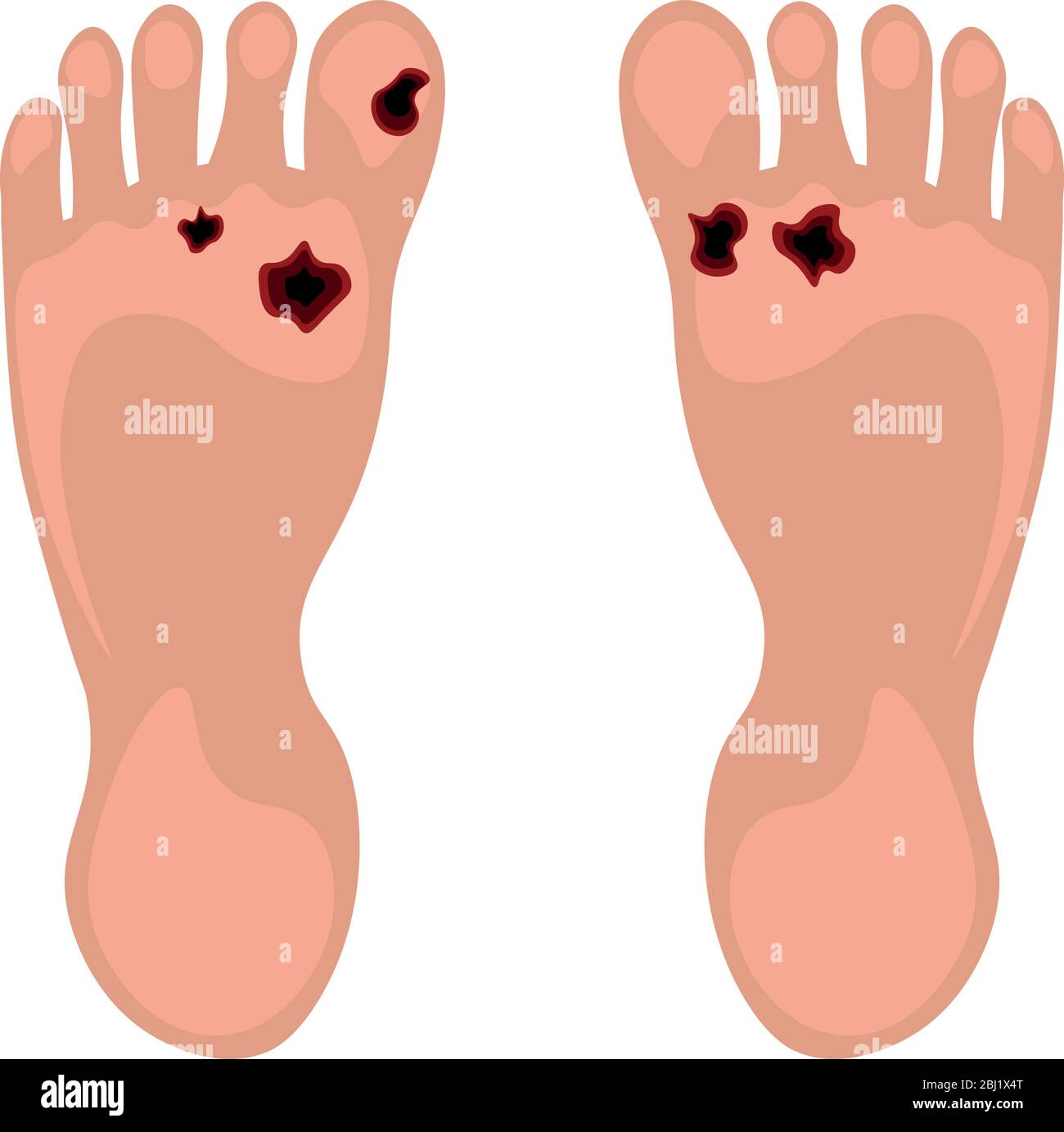 Diabetic foot. Endocrinological pathology. Ischemia and atherosclerosis ...