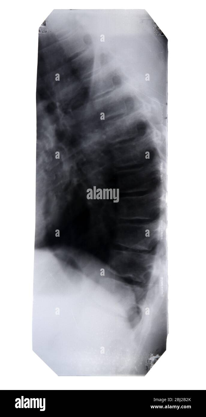 Normal chest radiograph hi-res stock photography and images - Alamy
