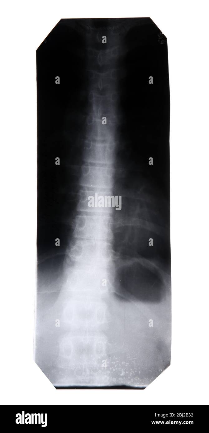 X-Ray image isolated on white Stock Photo - Alamy