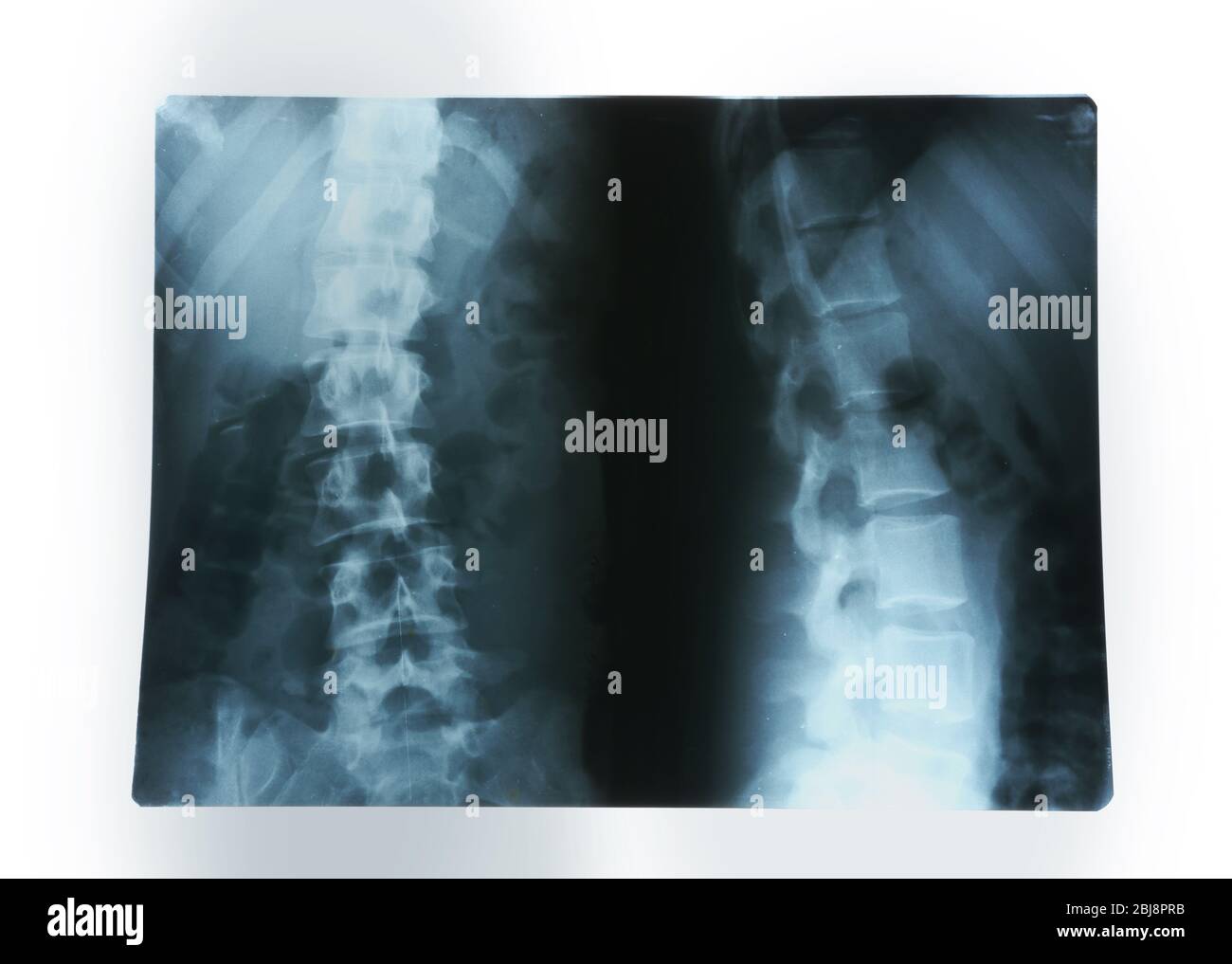 Spinal column xray hi-res stock photography and images - Alamy