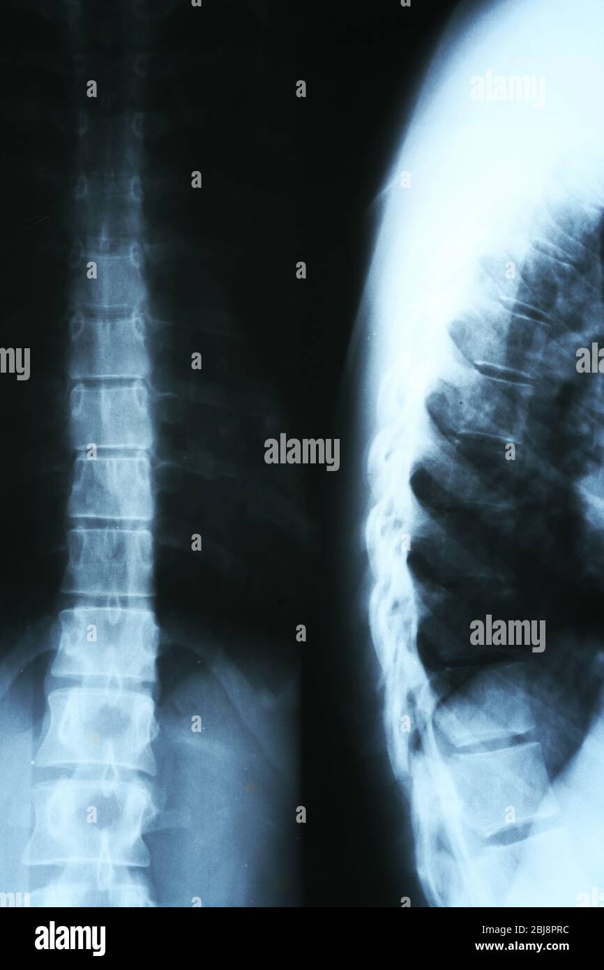 X-ray of human spinal column closeup Stock Photo - Alamy