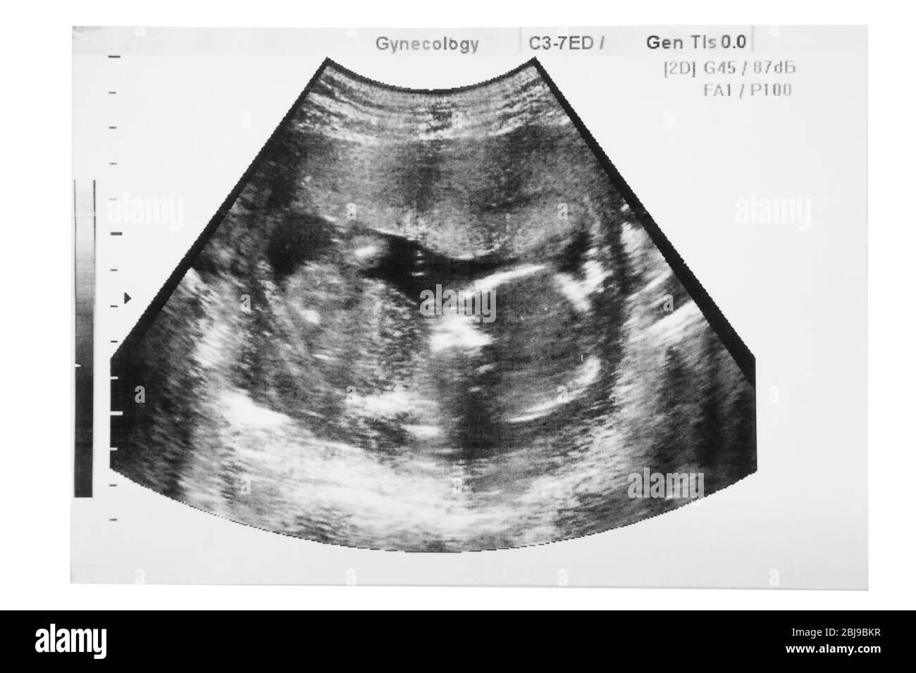 Ultrasonic sound Black and White Stock Photos & Images - Alamy