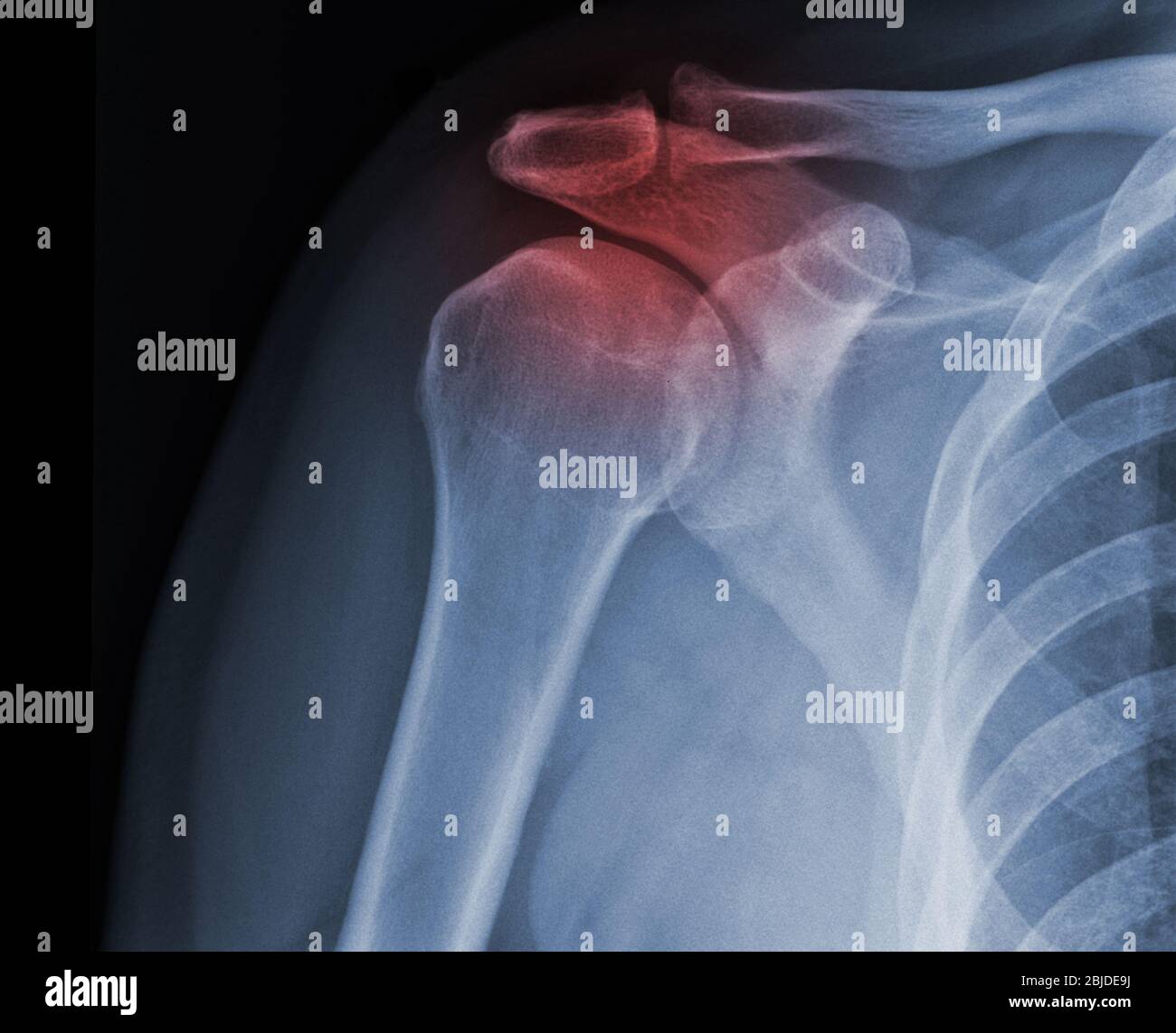X-ray shoulder radiograph show state of injury Stock Photo - Alamy