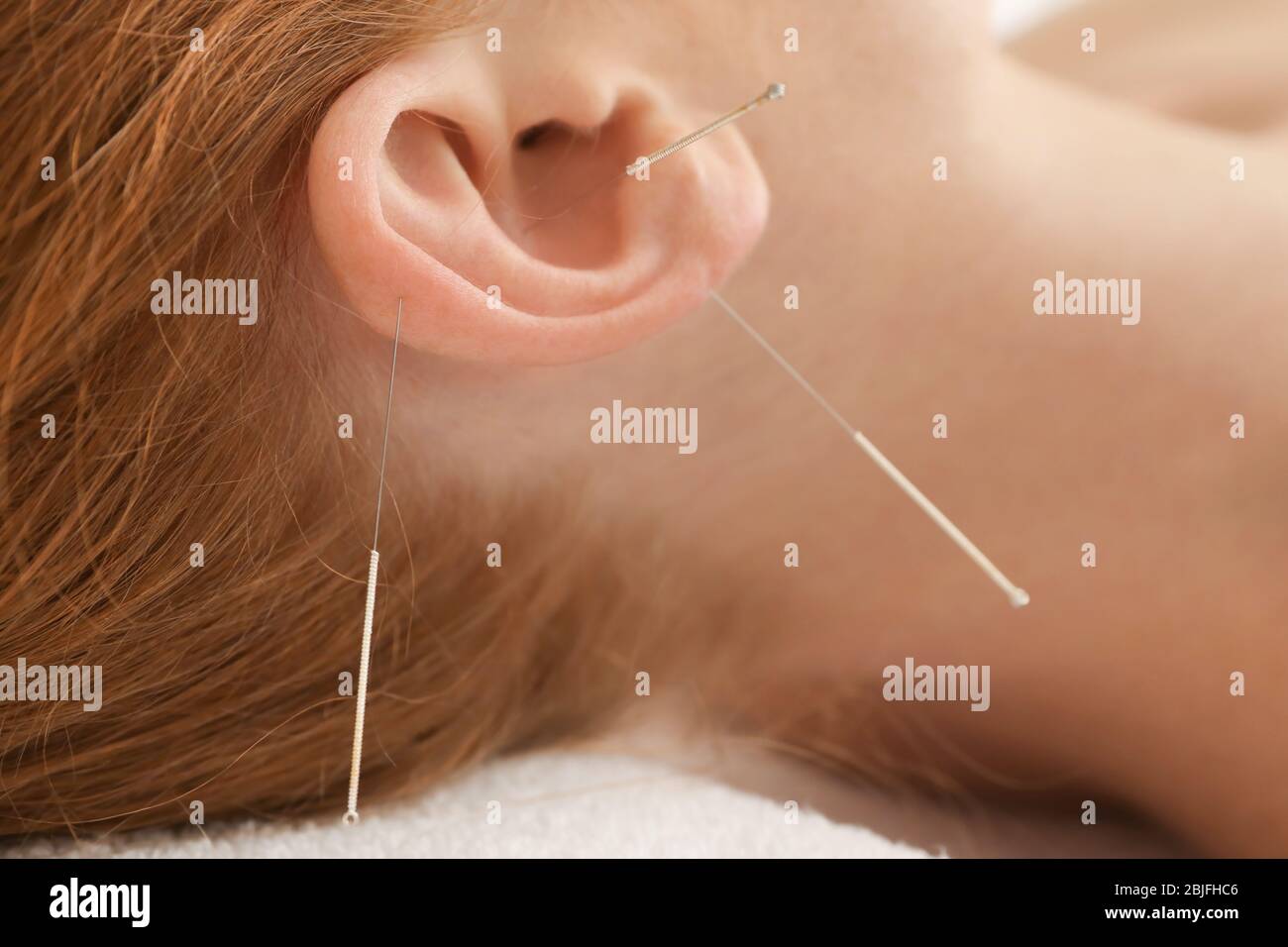 Therapy of female ear with pricking acupuncture needles Stock Photo - Alamy