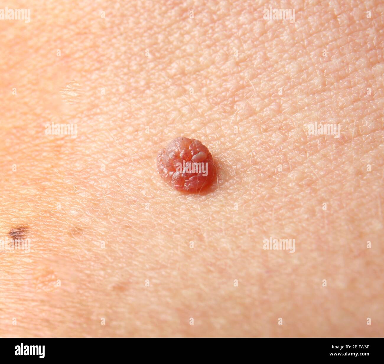 Human skin with birthmarks, closeup Stock Photo - Alamy