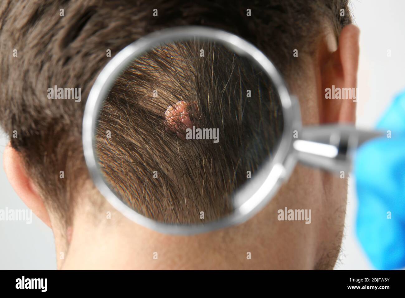 Dermatologist with magnifier examining patient in clinic, closeup Stock ...