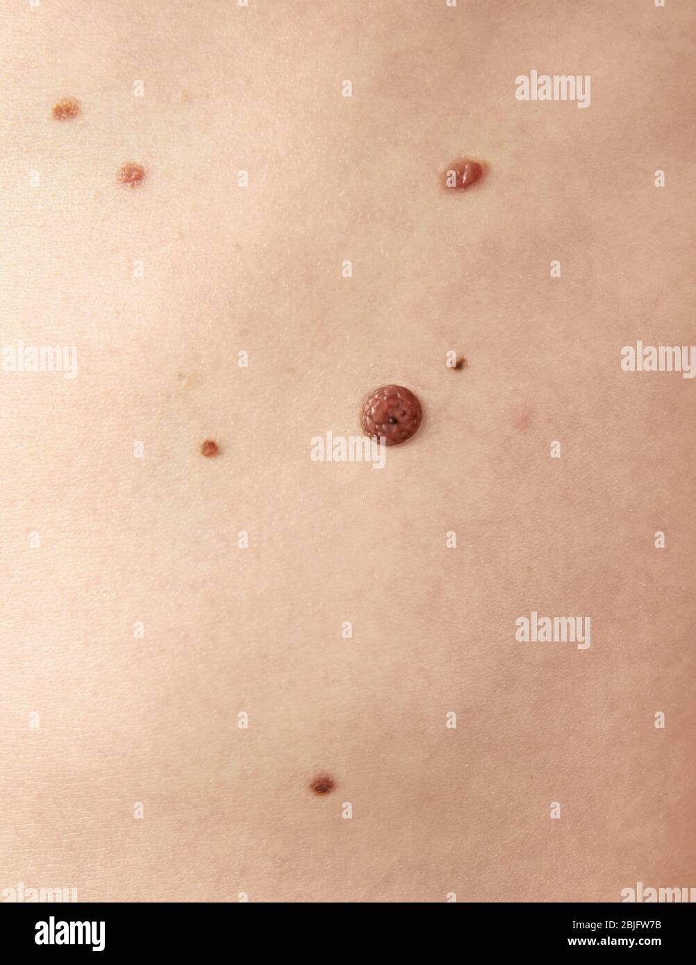 Young man with birthmarks on light background, closeup Stock Photo - Alamy