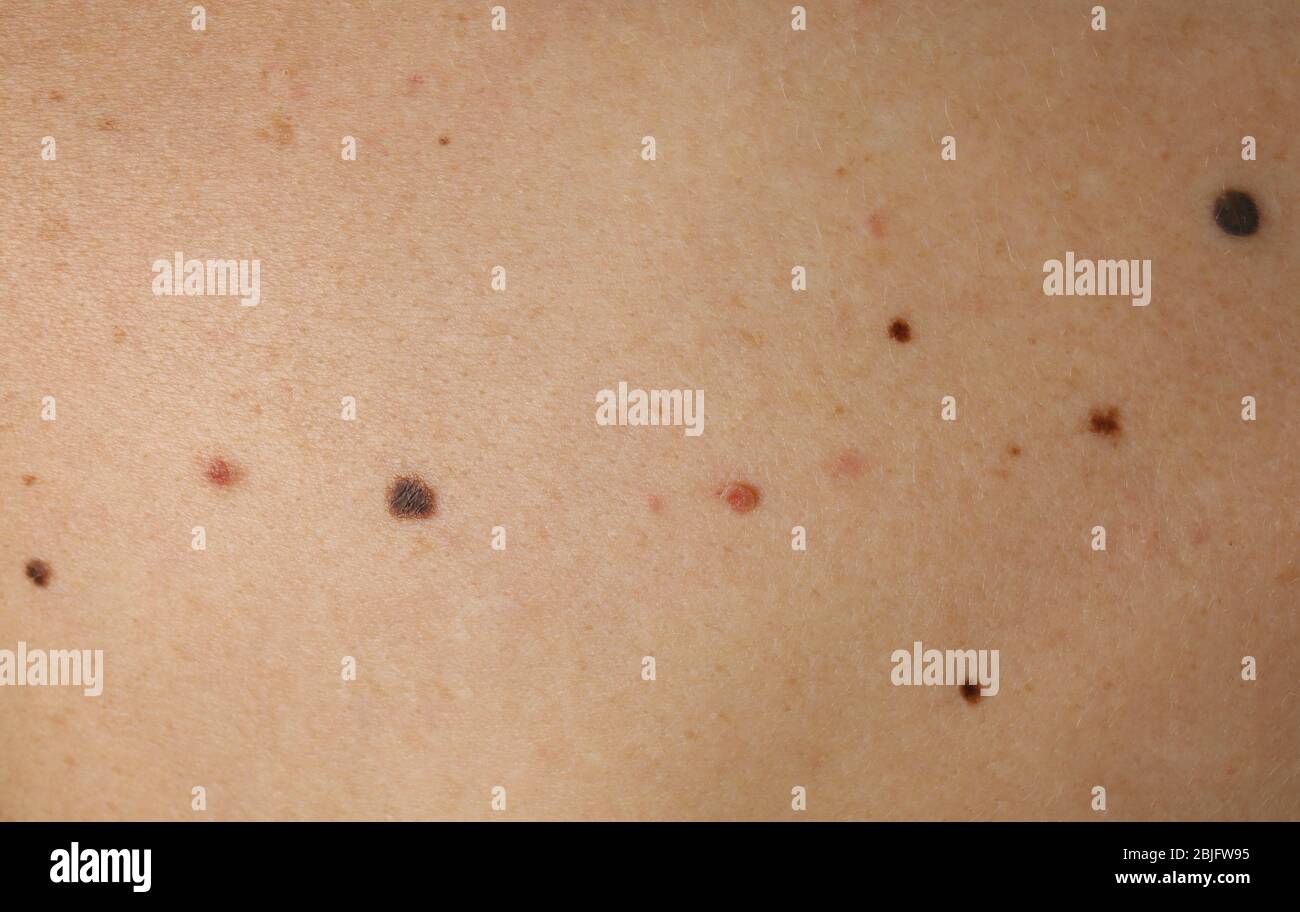 Human skin with birthmarks, closeup Stock Photo - Alamy