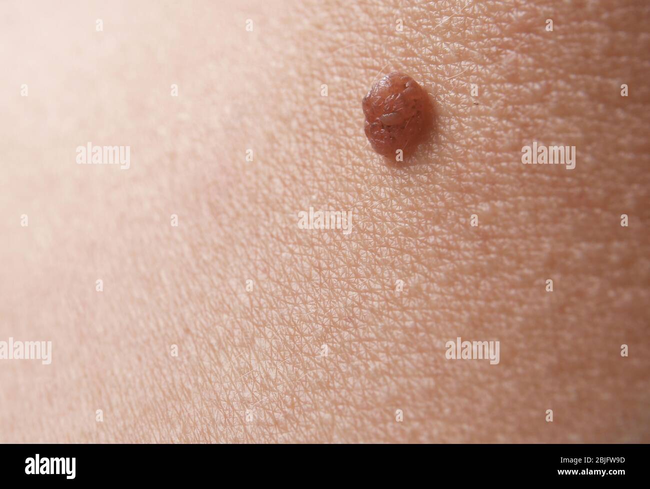 Human skin with birthmark, closeup Stock Photo - Alamy