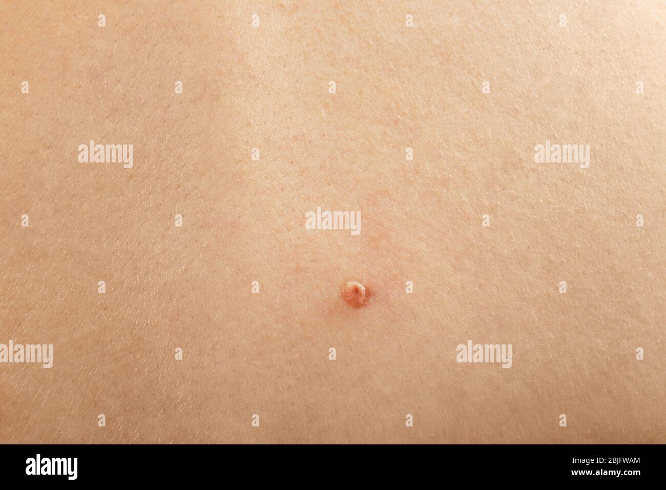 Human skin with birthmark, closeup Stock Photo - Alamy