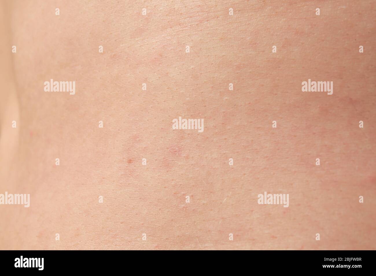 Human skin with pimples, closeup Stock Photo - Alamy