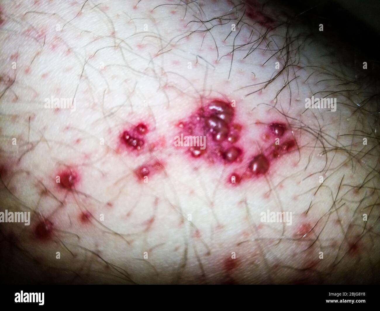 Shingles zoster herpes symptoms hi-res stock photography and images - Alamy