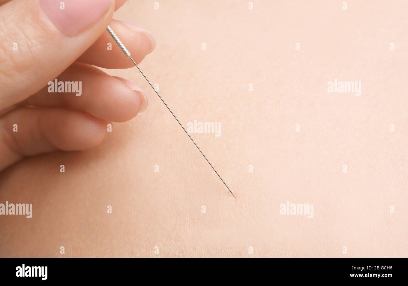 Woman stimulating acupuncture points on patient's back, closeup Stock ...