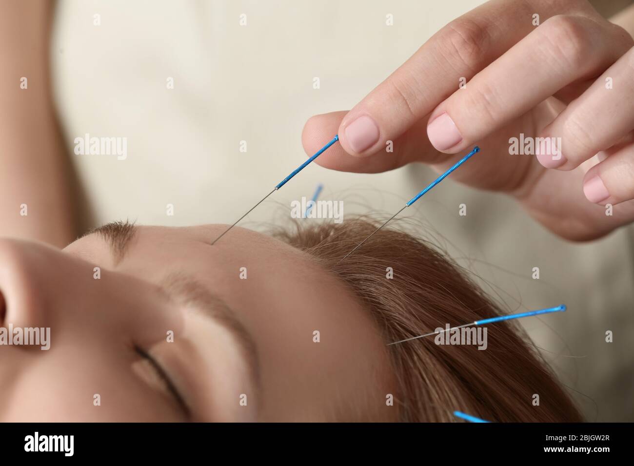 Woman acupuncture head hi-res stock photography and images - Alamy