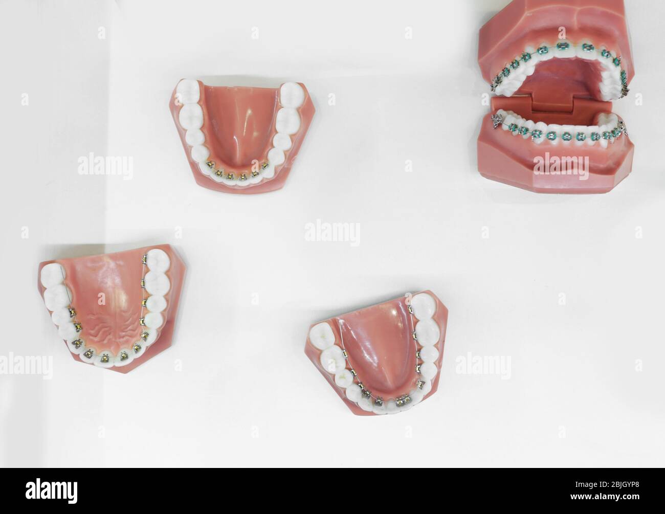 Set of jaw models with dental bracket on white background Stock Photo ...