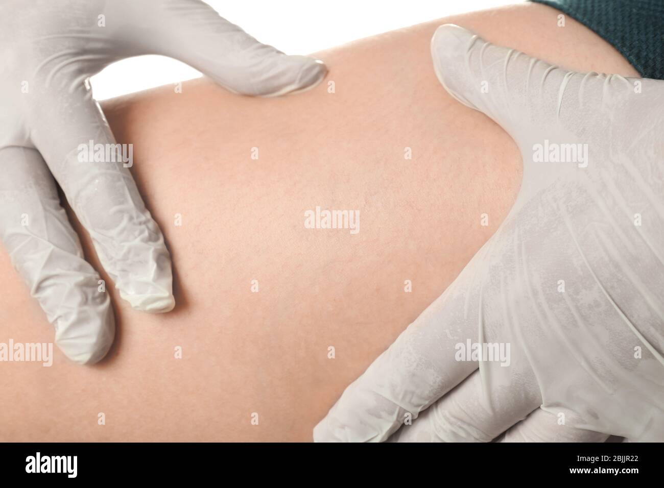 Doctor examining woman's leg for varicosis, closeup Stock Photo - Alamy