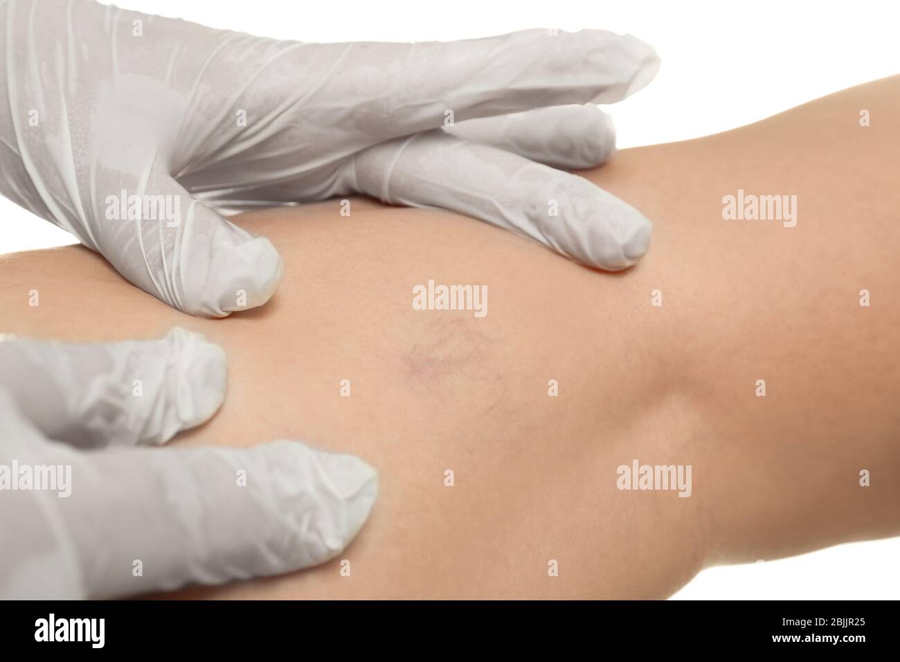 Varicosis hi-res stock photography and images - Alamy