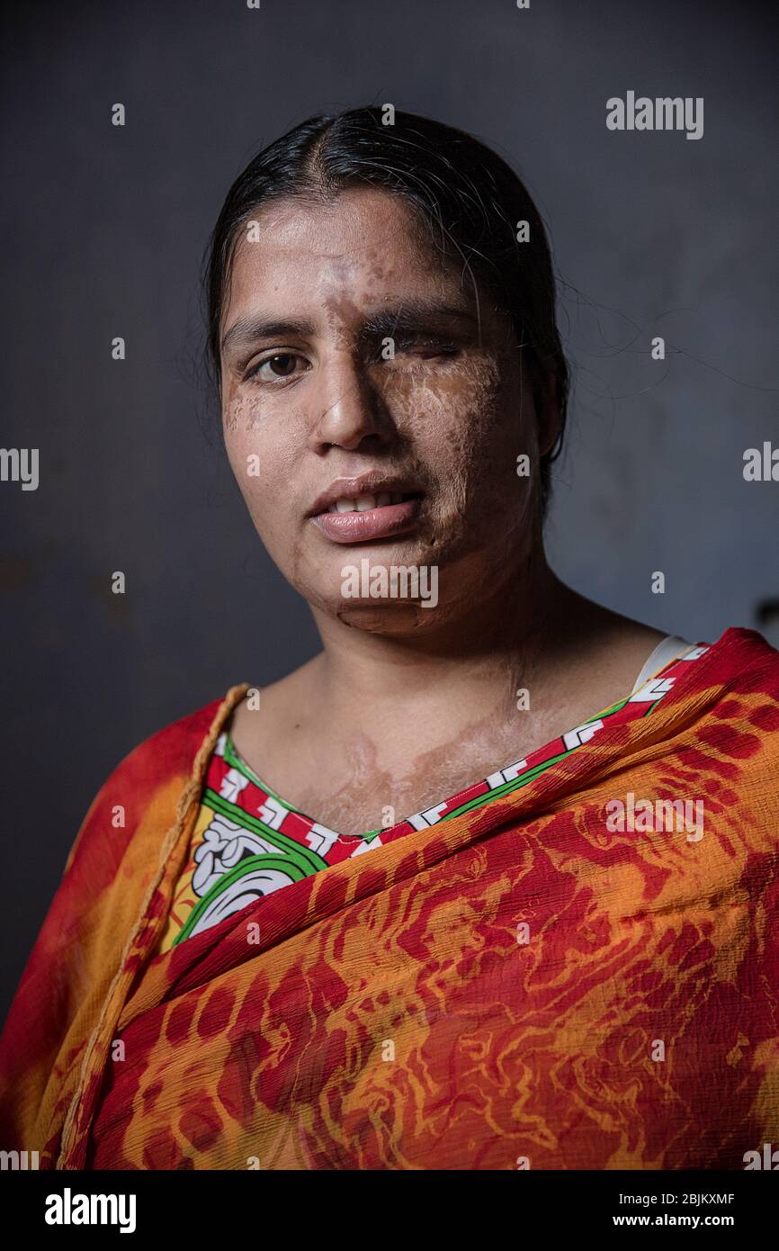 Skin burn scars hi-res stock photography and images - Alamy