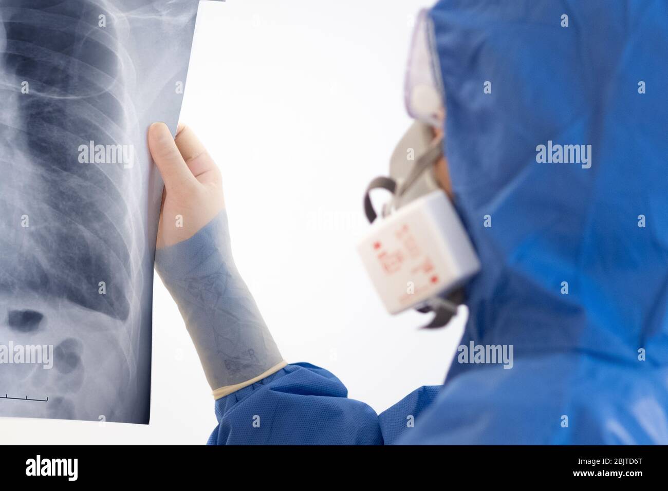 Pneumonia lungs xray hi-res stock photography and images - Alamy