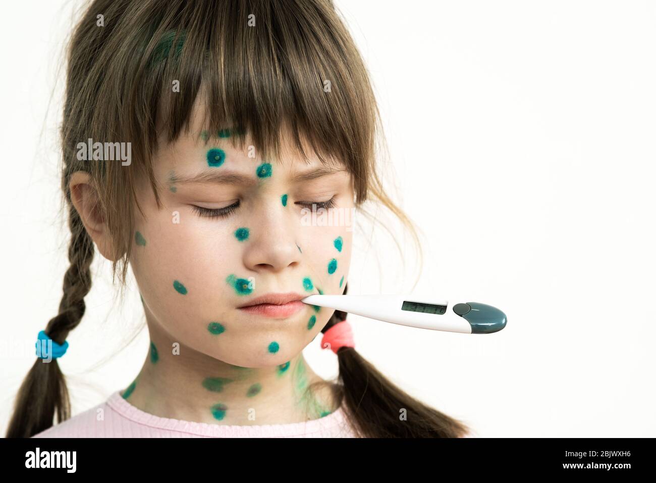 Child girl covered with green rashes on face ill with chickenpox ...