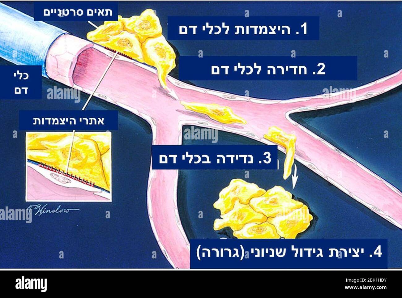 Metastasis hi-res stock photography and images - Alamy