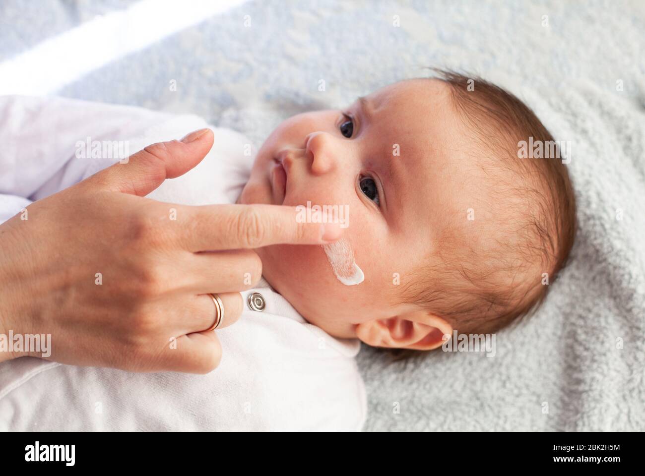 Baby with atopic dermatitis getting cream put. Care and Prevention Of ...