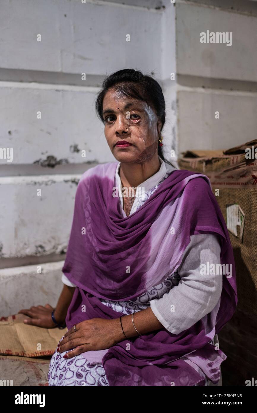 Acid attack survivor, India Stock Photo - Alamy