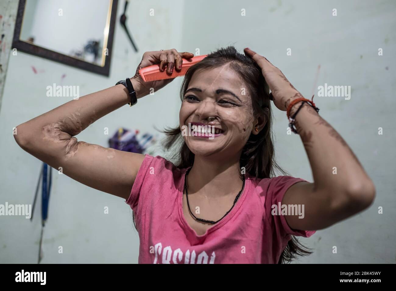 Scars Arm High Resolution Stock Photography and Images - Alamy