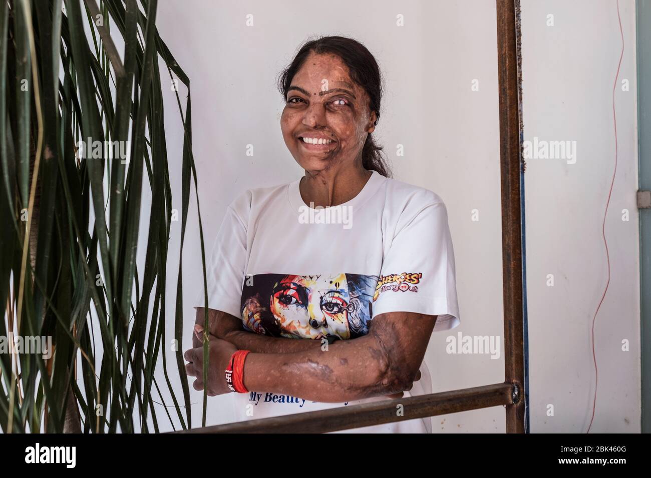 Acid attack survivor, India Stock Photo - Alamy