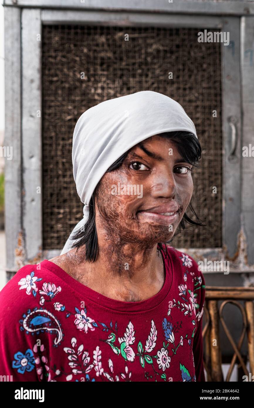 Acid attack survivor, India Stock Photo - Alamy