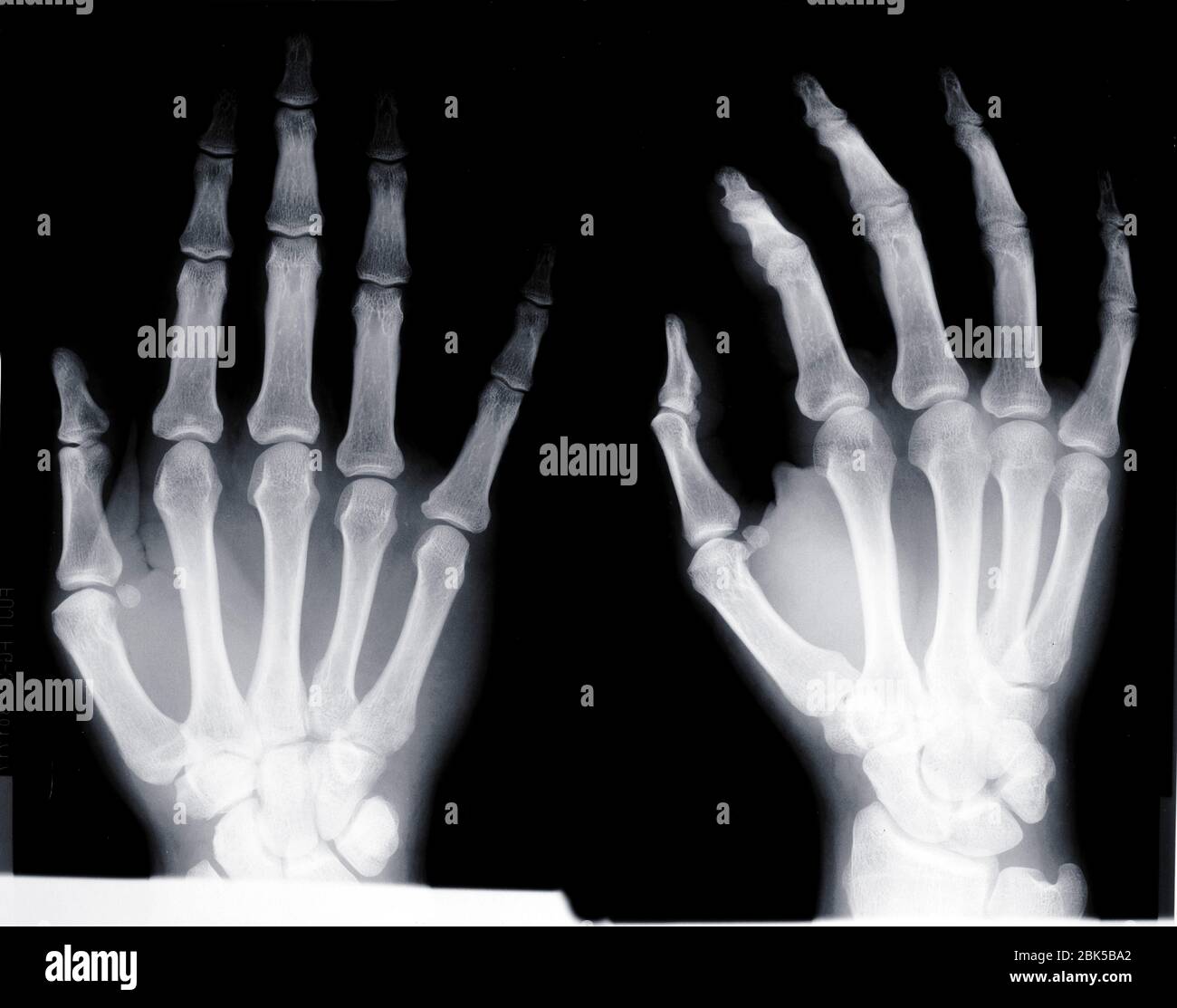 Human hands, X-ray Stock Photo - Alamy
