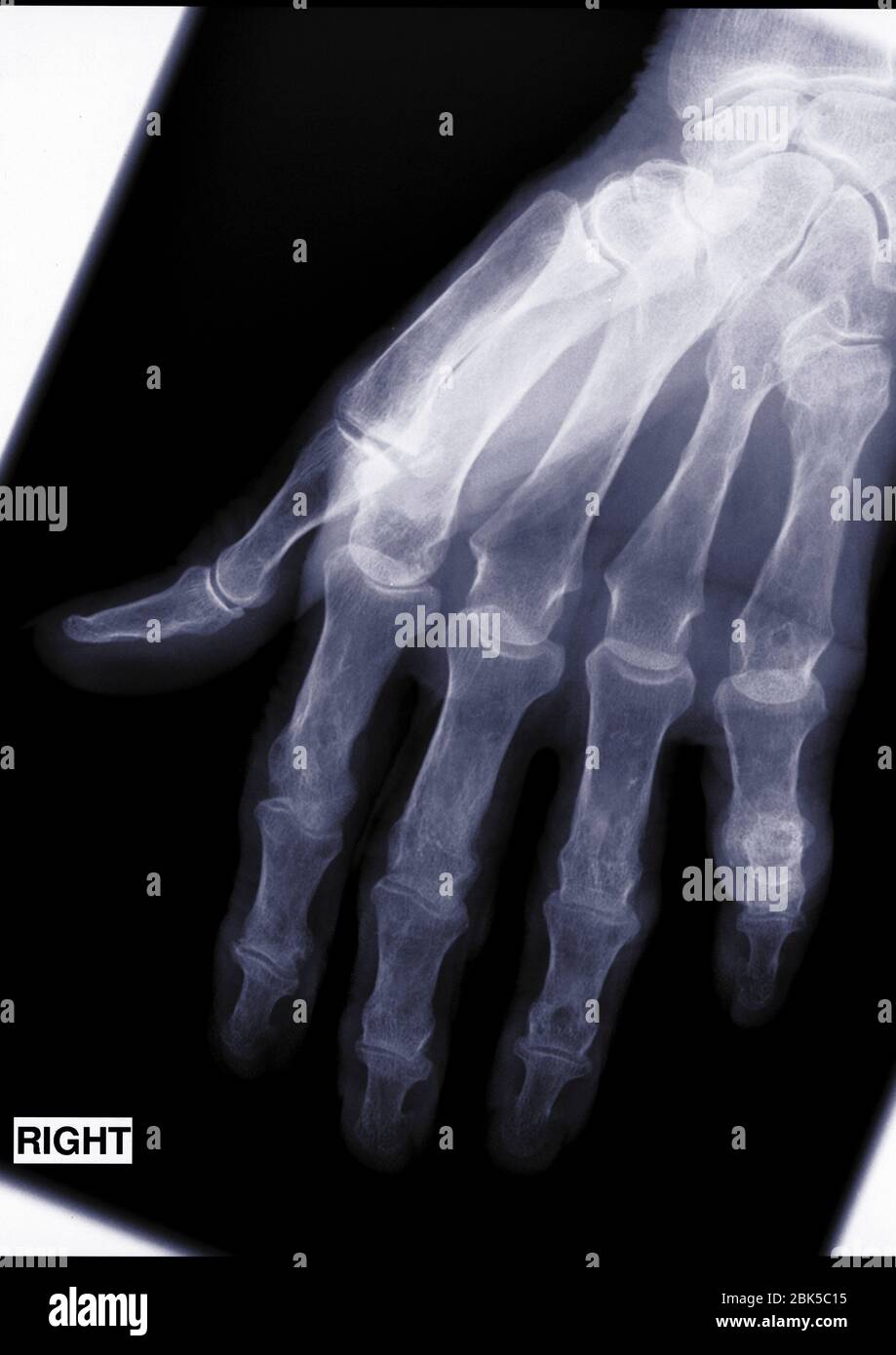 Hand X Ray High Resolution Stock Photography and Images - Alamy